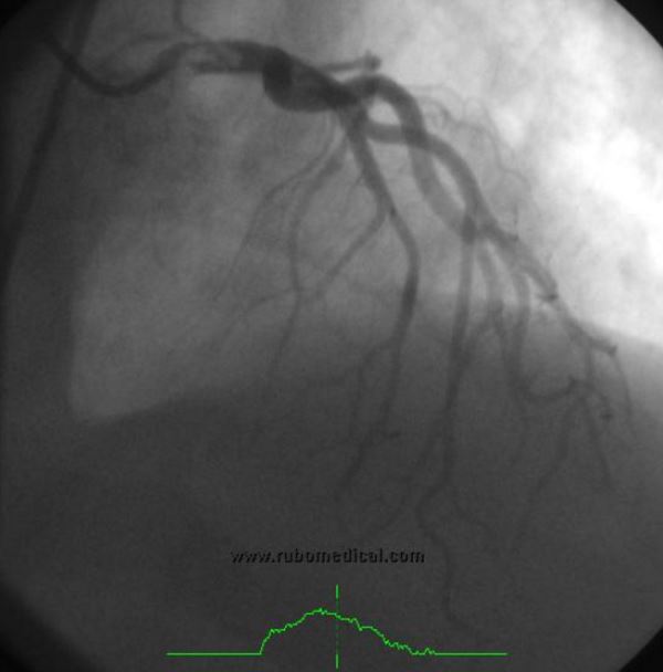 STEMI Patient with Large Thrombus in LM Treated with Full Dose Intracoronary Thrombolytic ...